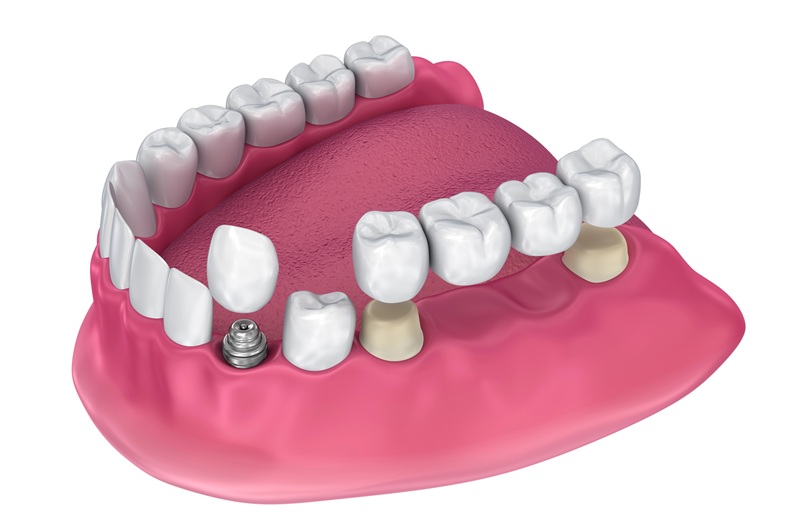 Dental Crowns Oakbrook Terrace IL | Dental Bridges